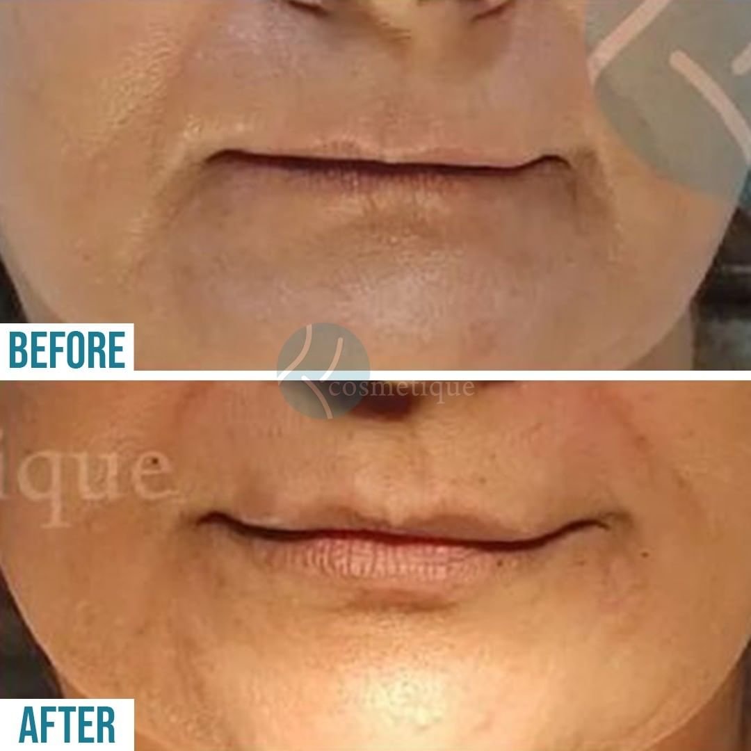 Lip Beautification with Skin Fillers