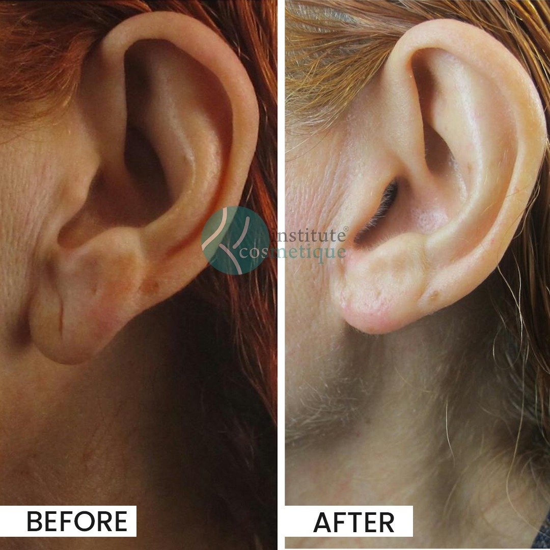 Ear Reshaping | Otoplasty Surgery in Pakistan for Protruding Ears